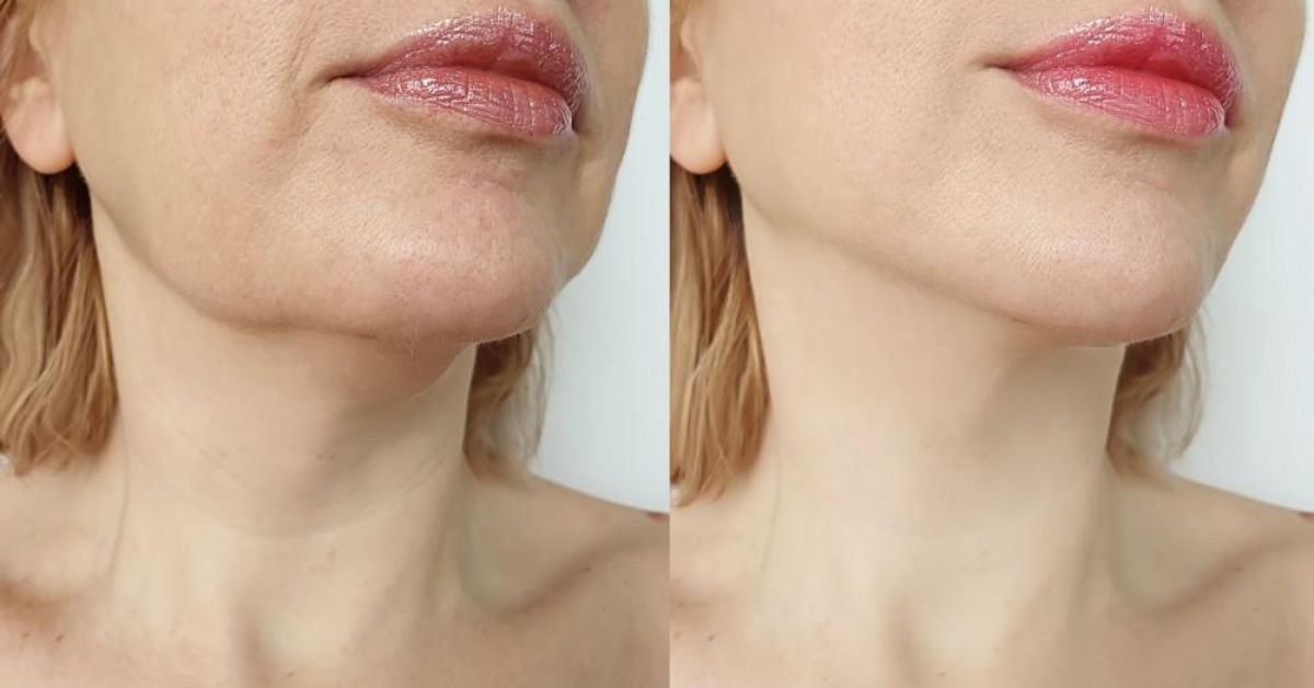 Jowls: Causes, Prevention, and Your Comprehensive Treatment Guide ...